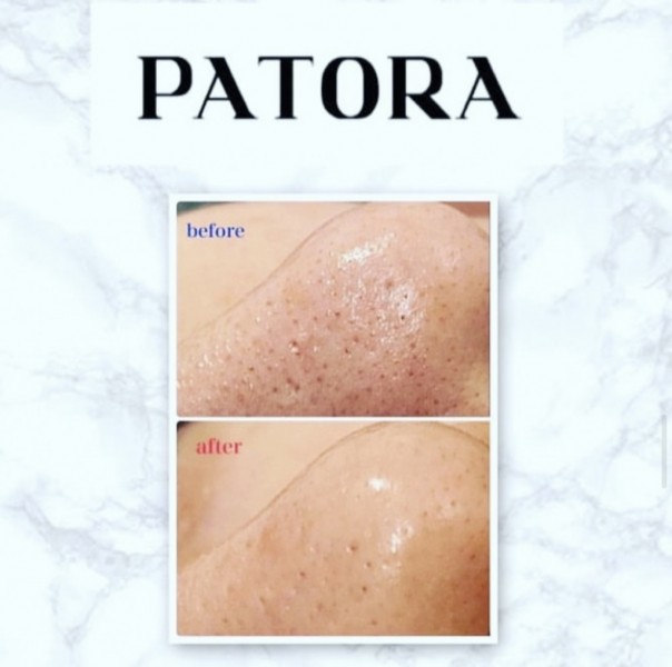 毛穴ケア | ブログ | 【公式】PATORA｜33年の実績と11.7万人の信頼｜オールハンド専門エステサロン